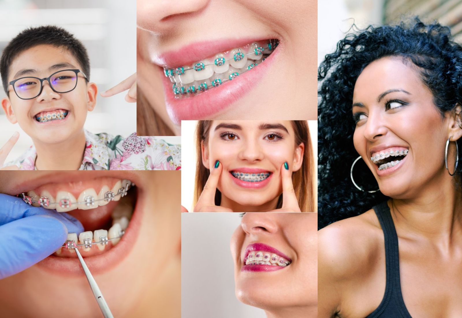 The Ultimate Guide to Getting Braces in Chicago: What You Need to Know
