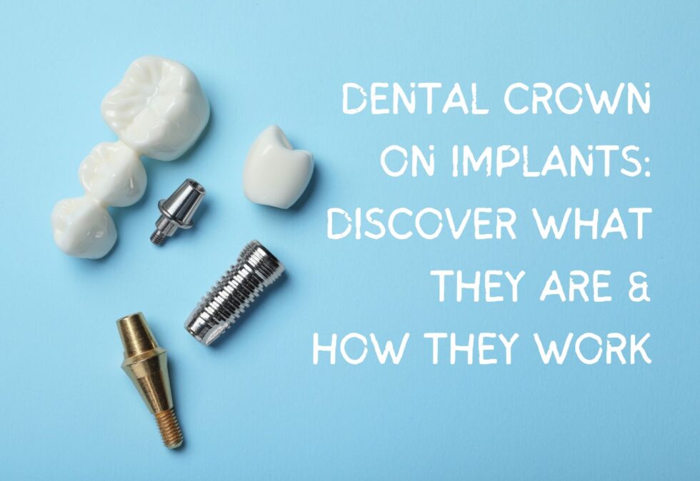 Dental Crowns on Implants: The Key To Your New Smile | ABC Dental l ...