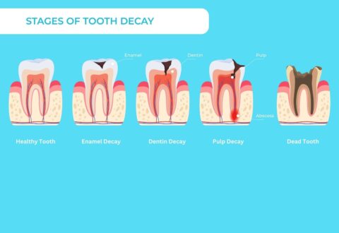 What are the stages of tooth decay? | ABC Dental l Rated Best Chicago ...